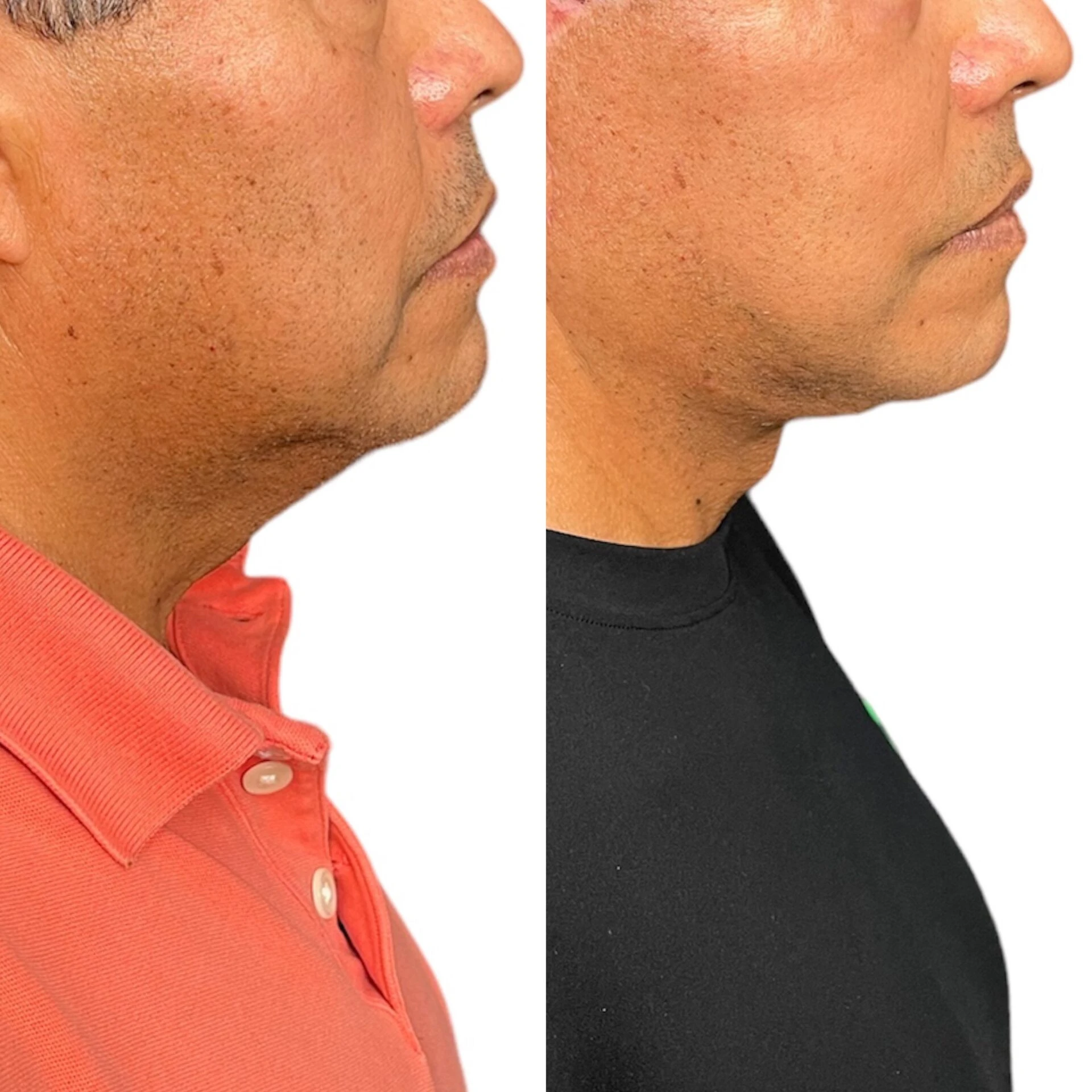 Neck Lift Los Angeles, CA | LA Body Sculpture